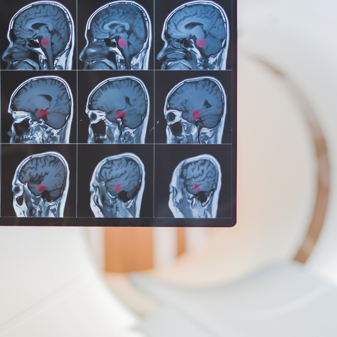 Beyin ve Sinir Cerrahisi - Bedigital Hospital